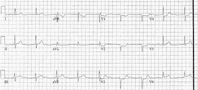 ECG of the Week: ECG of the Week - 3rd September 2012