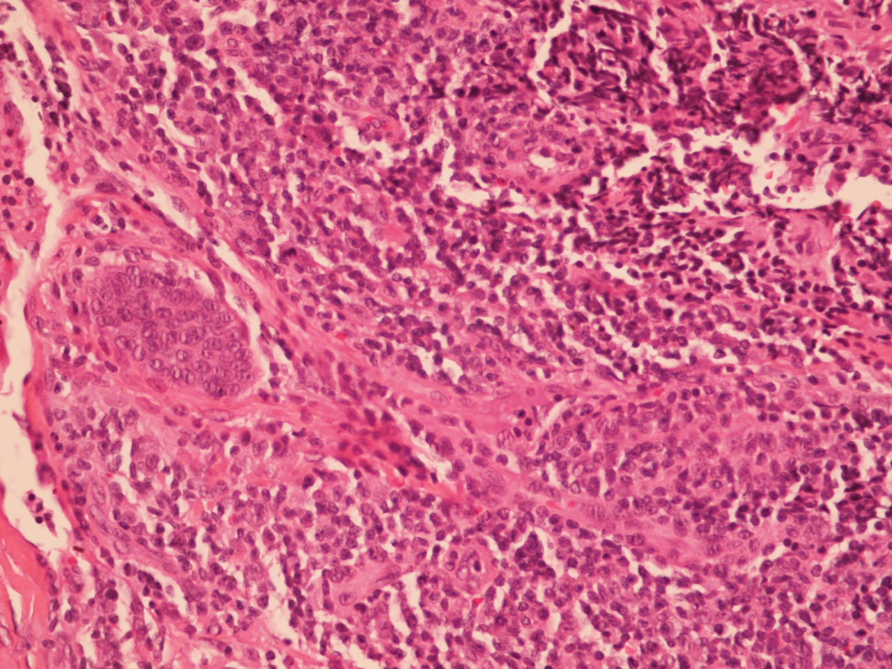 VIRTUAL GRAND ROUNDS IN DERMATOLOGY 2.0: Nasal Tumor for Diagnosis