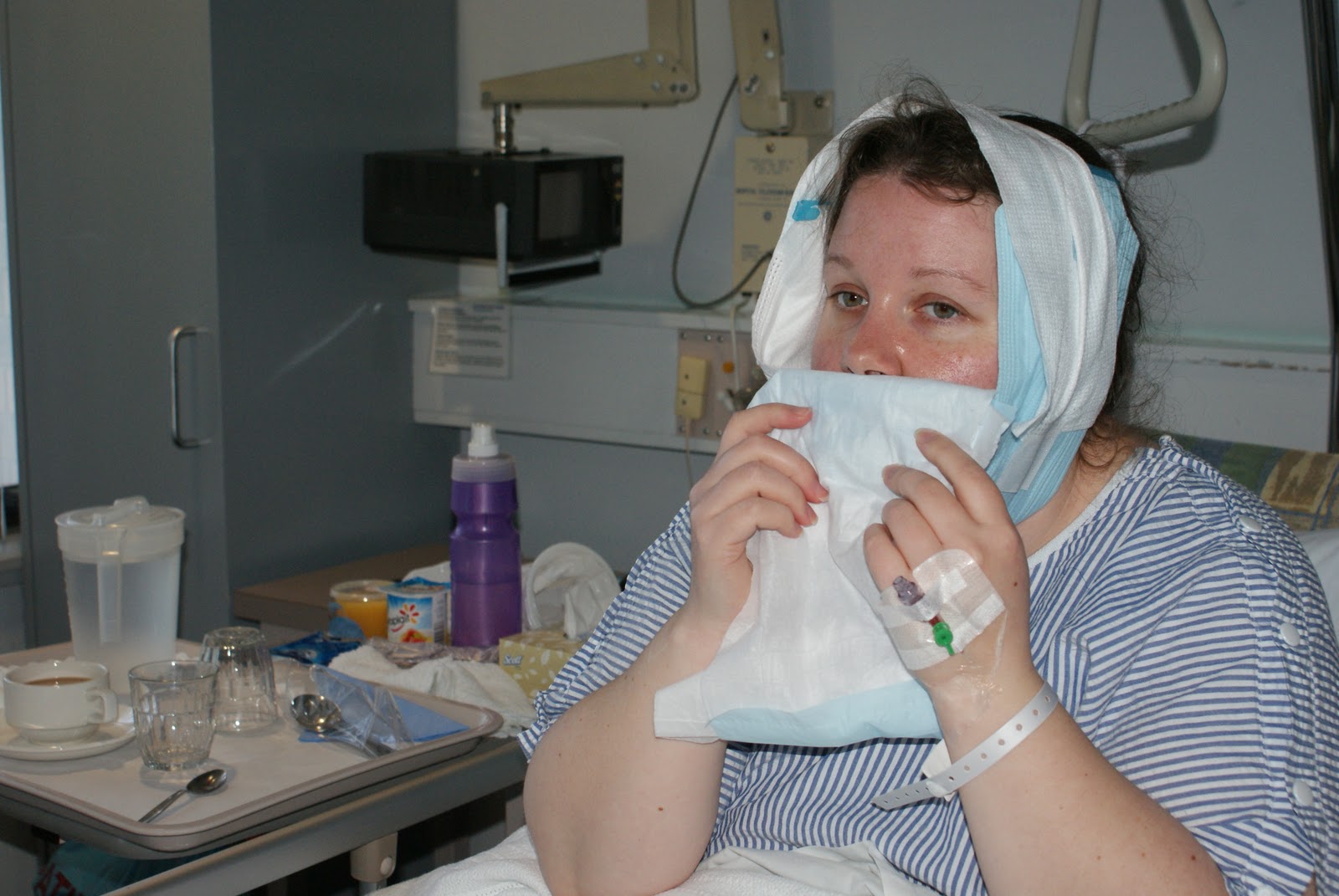 Braces + SARPE/SARME Surgery