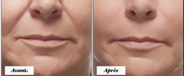 LE SILLON NASOGÉNIEN, LA LIMITE HAUTE DU SOURIRE