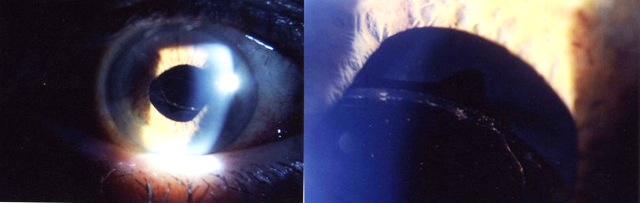 GLAUCOMA SPECIALIST BLOG: "THE GLOG": PIGMENTARY GLAUCOMA