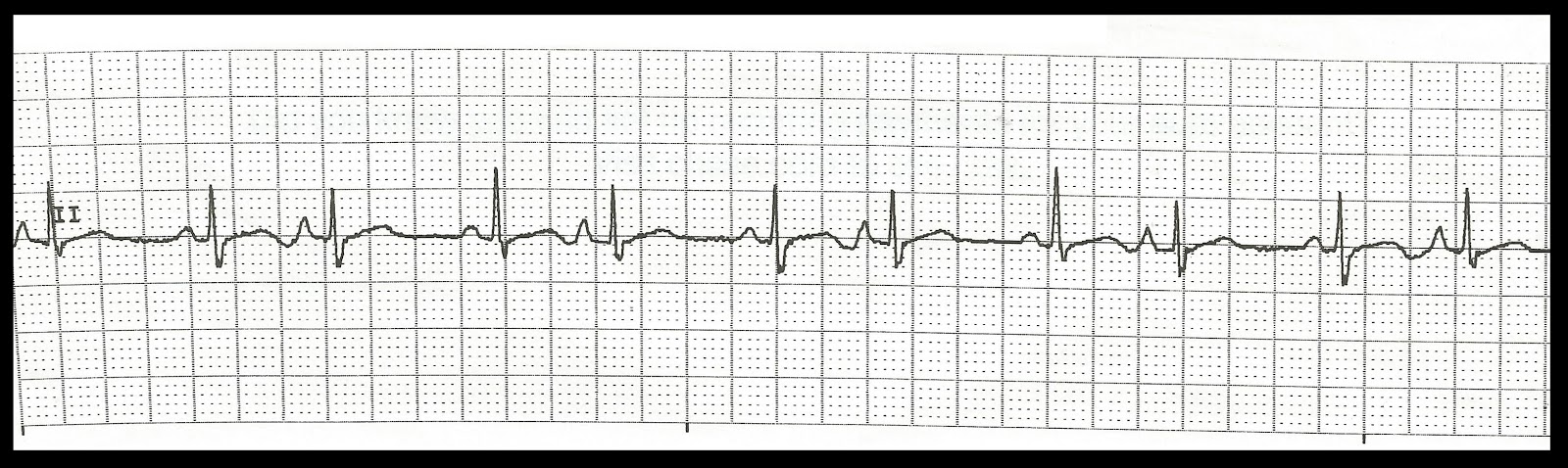 Practice EKG Rhythm Strips 187