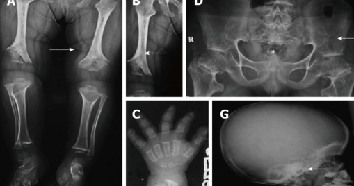 Achondroplasia Clinical Presentation