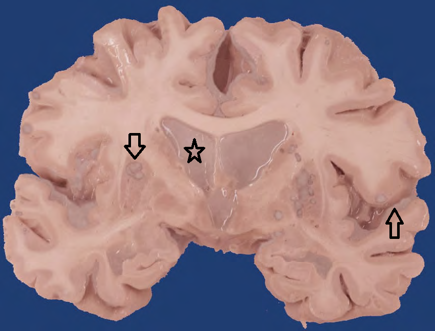 Histopatología: Criptococosis