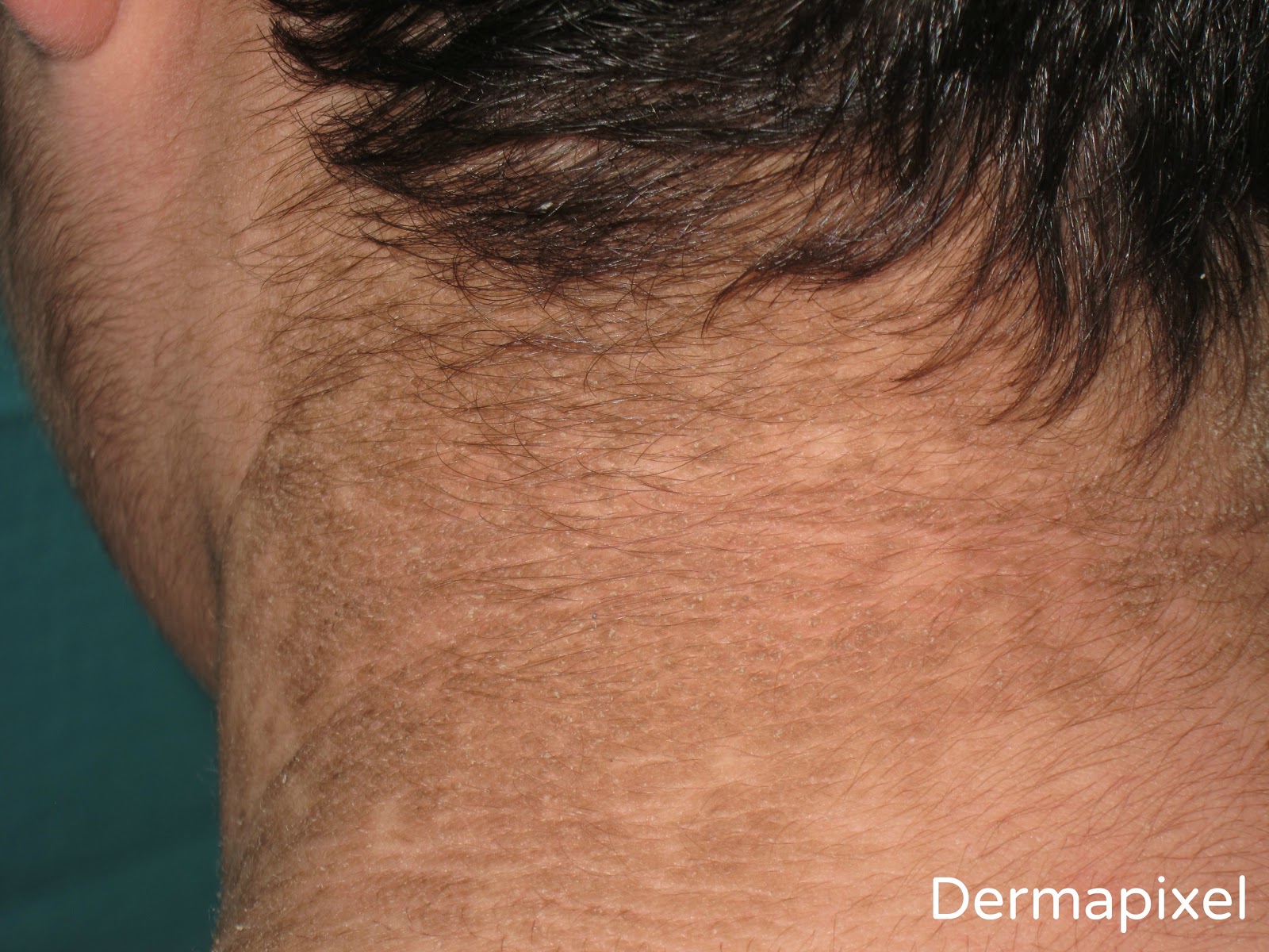 Dermapixel: septiembre 2017