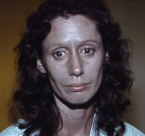 SALUD Y MEDICINA: La Argiria