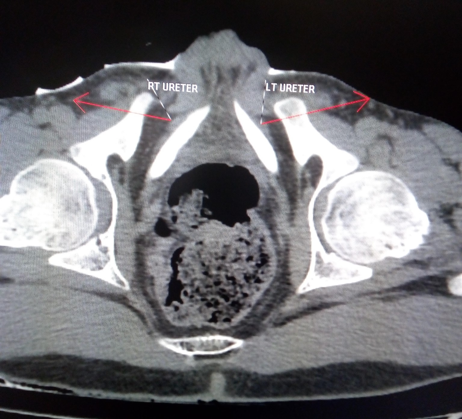 Bladder exstrophy – CT - Sumer's Radiology Blog