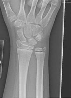 Unusual secondary ossification center for scaphoid tubercle-Plain Film ...