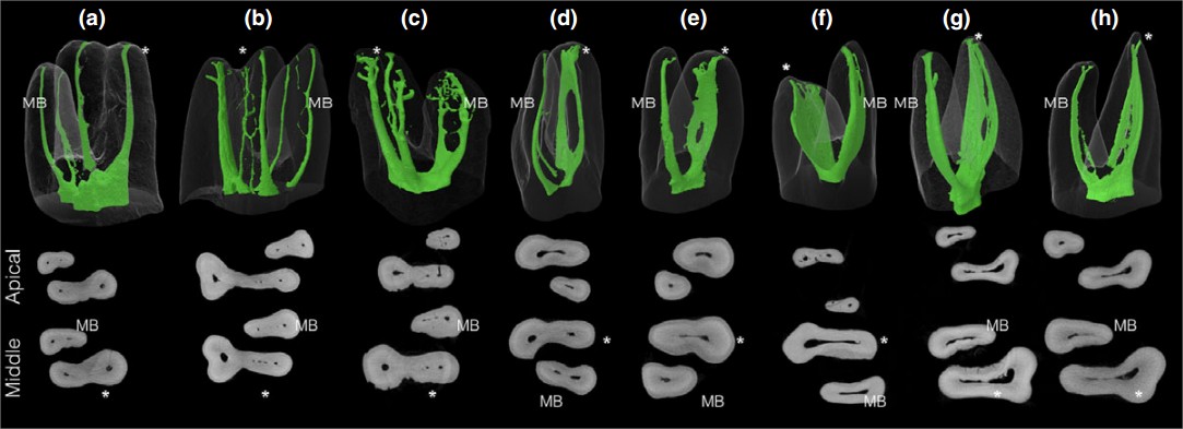 The Root Canal Anatomy Project: Fused Maxillary 2nd Molars ...