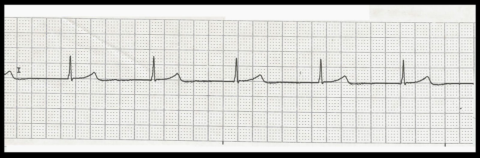 Junctional escape rhythm ecg strip - denisgeek