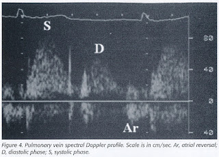 Pedi cardiology: Diastolic Function by Doppler - Mitral Inflow ...