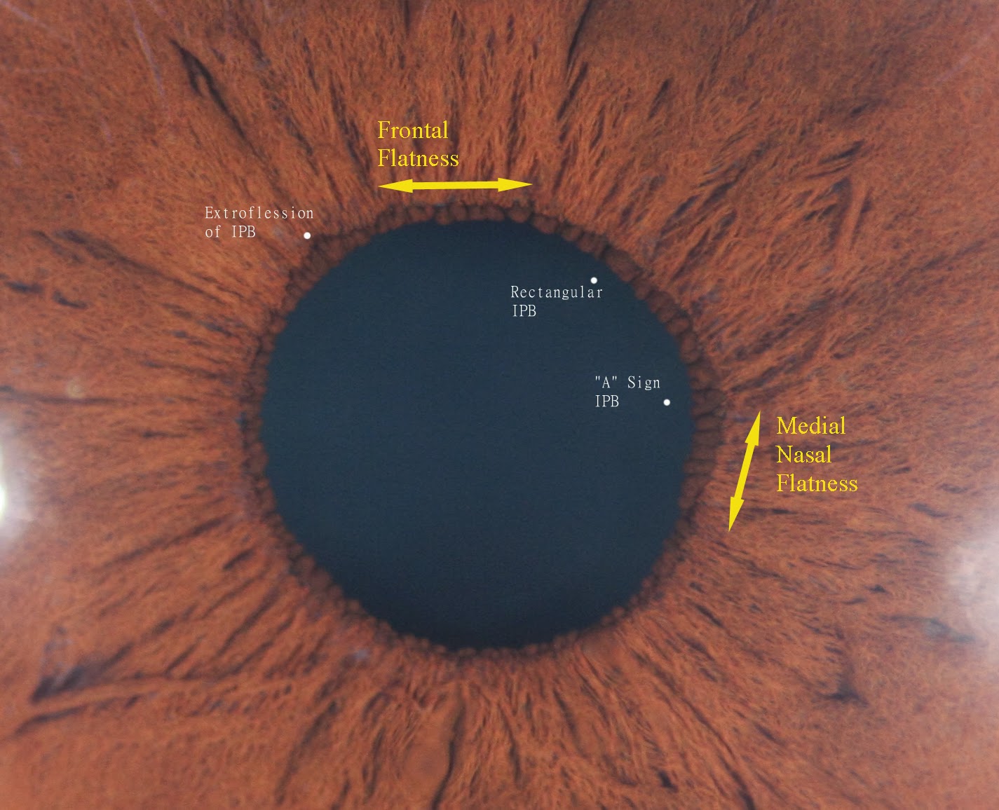 Modern & Multidimensional Iridology: IPB Morphologies, Pupil Flatness ...