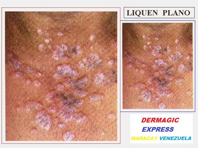 EL LIQUEN PLANO, REVISIÓN. / THE LICHEN PLANUS, A REVIEW. - DERMAGIC EXPRESS / Dermatologia y ...