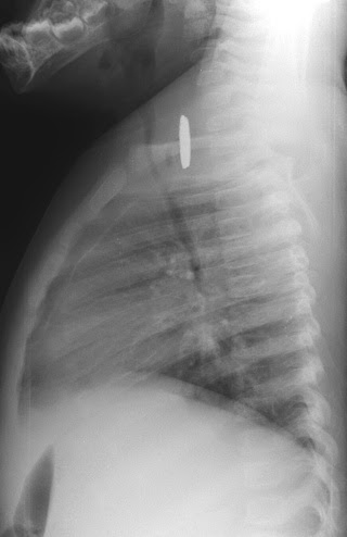 Random Rambles: Button battery vs coin ingestion