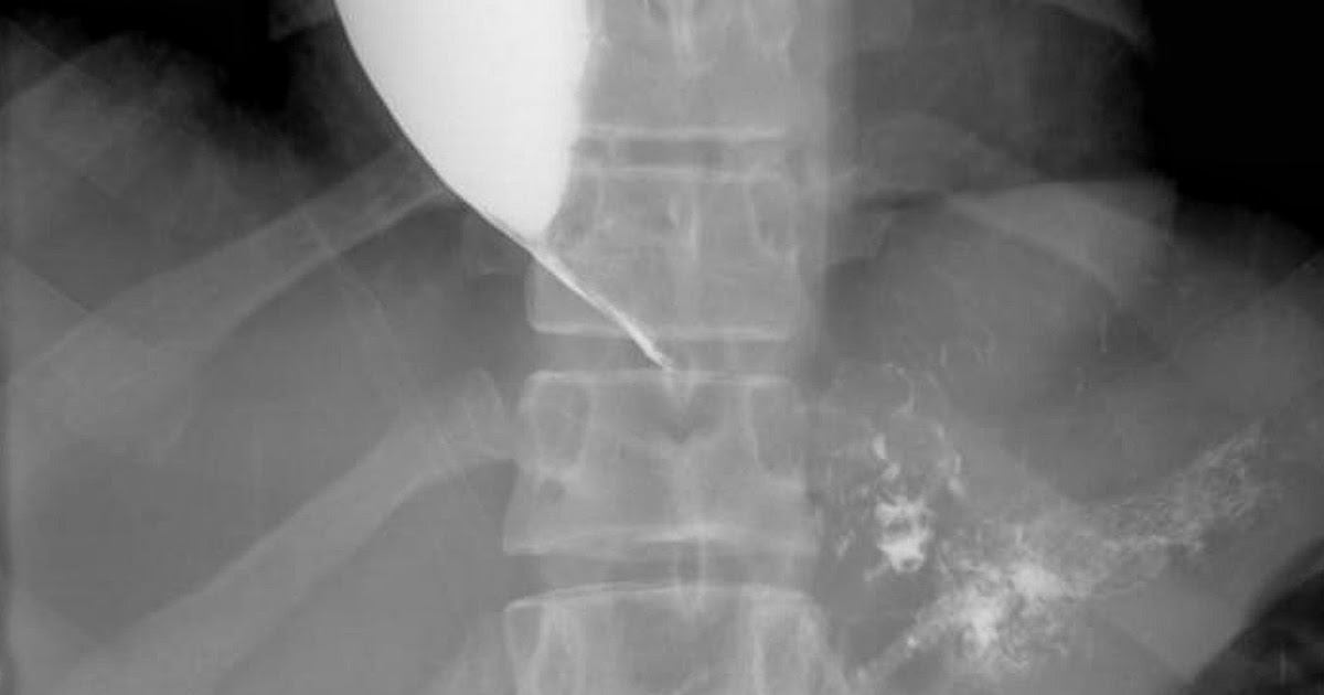 Rheobase Medical: Achalasia Cardia