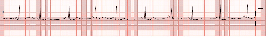EKG Rhythm Strips 16: Atrial Rhythms