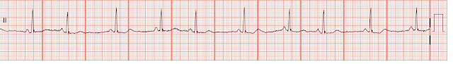 EKG Rhythm Strips 16: Atrial Rhythms