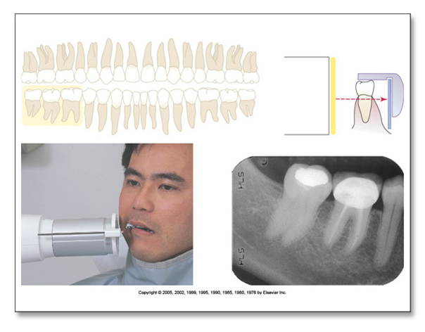 Dentistry and Medicine: Intraoral Radiographic Techniques (Paralleling ...