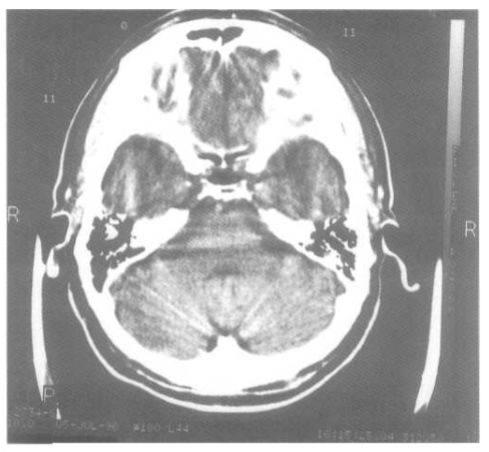 Konsultasi Dokter Keluarga: Cara Mudah Baca CT Scan Kepala