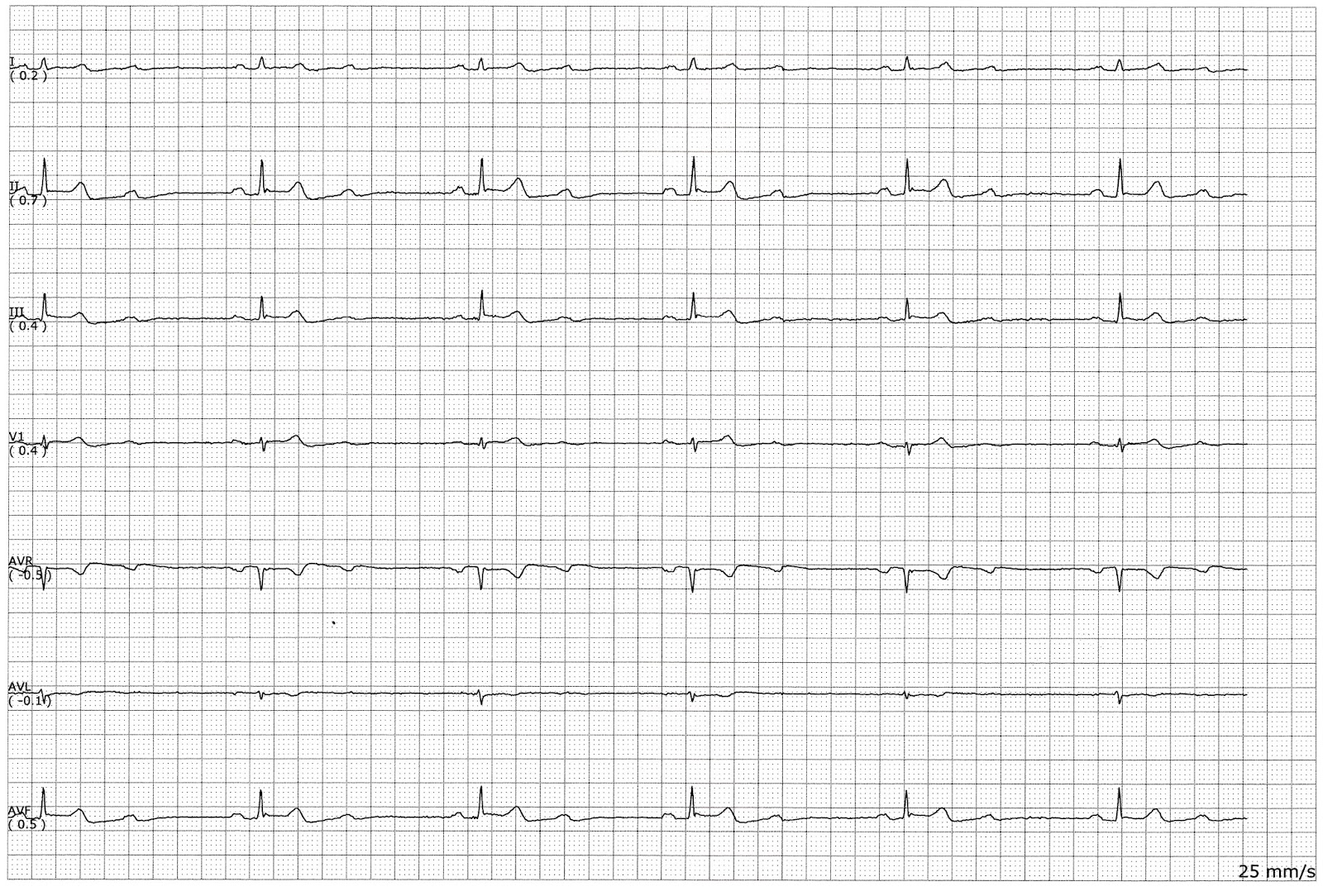 2nd Degree Heart Block Type II