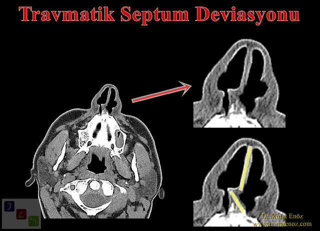 Traumatic Caudal or Anterior Septal Discolation and Treatment Difficulties