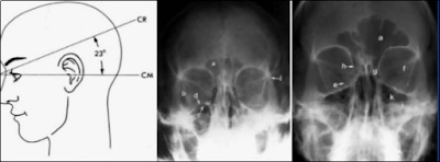 Tugas Sampah Koas: Radiologi-SINUSITIS