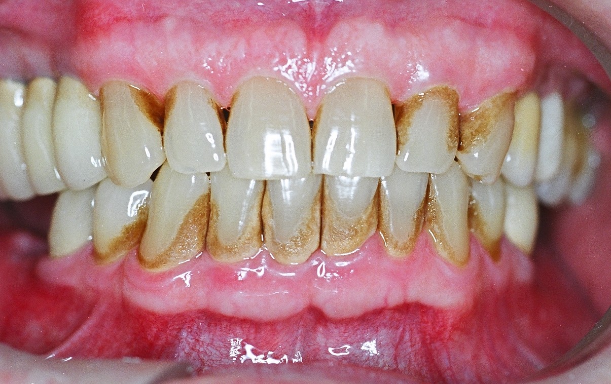 Periodontia.JPG (1205×758) | Periodontia