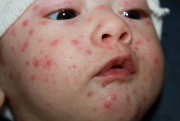 Obat Herbal Cacar Air