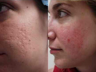 √ Acne Scars - Using enzymes to remove acne scar - GoodBye Acne