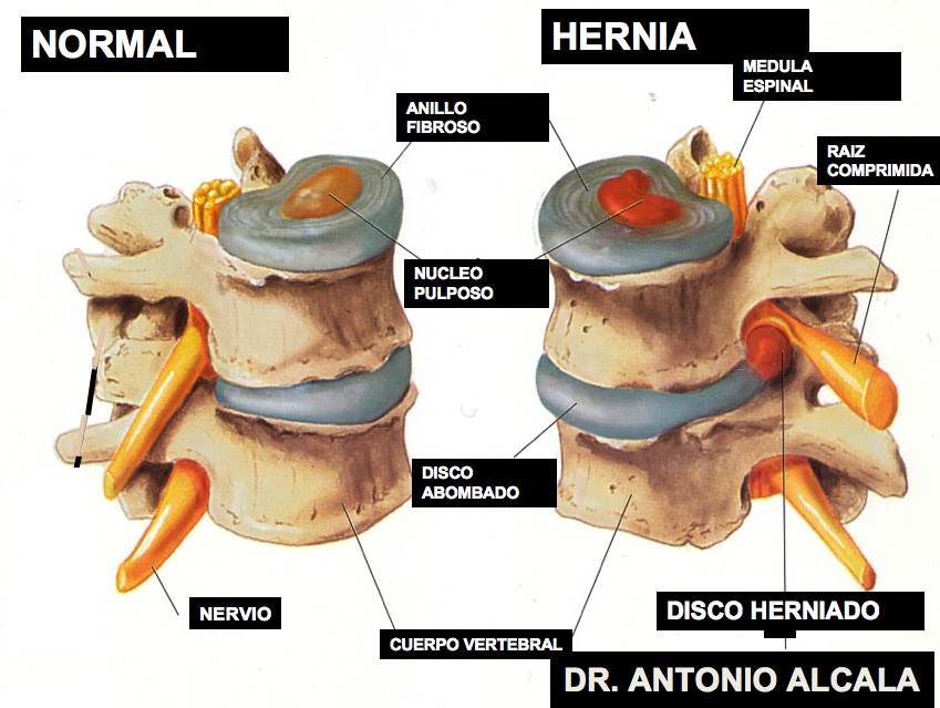 Desplazamiento del disco intervertebral; Hernia Discal; Disco Herniado ...