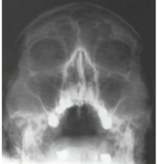 Tugas Sampah Koas: Radiologi-SINUSITIS