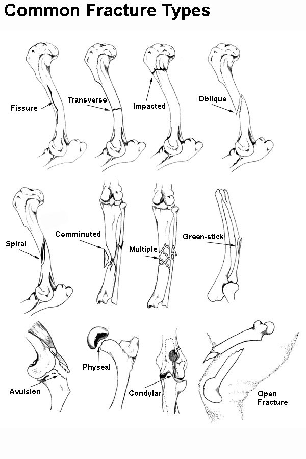 How Do Broken Bones Heal?