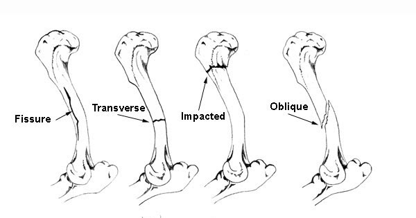How Do Broken Bones Heal?