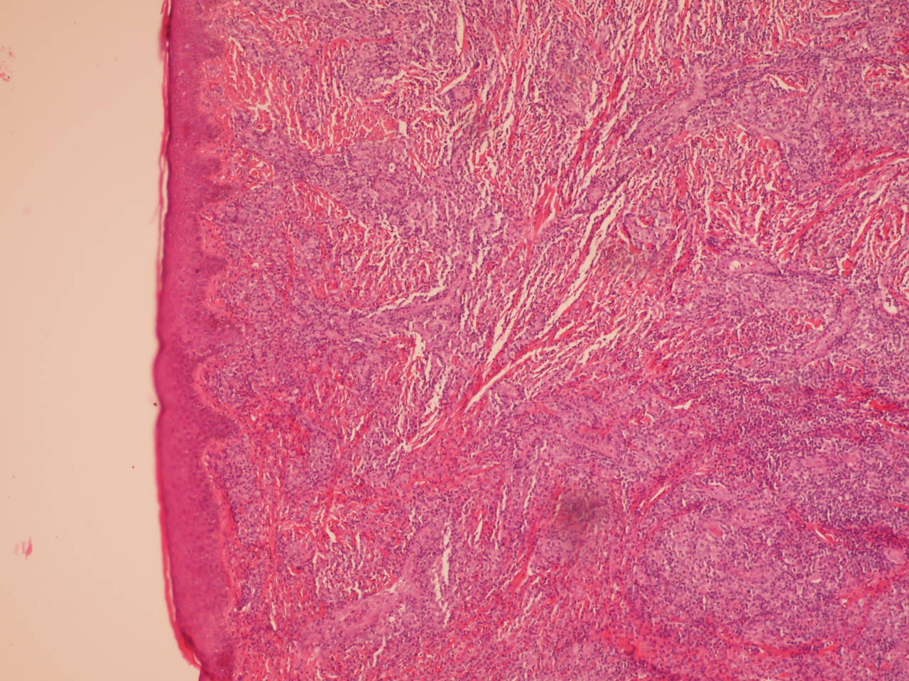 VIRTUAL GRAND ROUNDS IN DERMATOLOGY 2.0: Nasal Tumor for Diagnosis