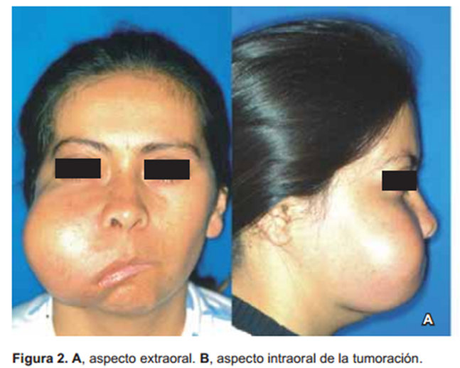 Alteraciones3301: Mixoma Odontogénico