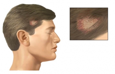Micologia: Tiña Capitis