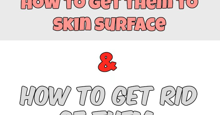 Pimples under the skin – How to get them to skin surface and how to get ...