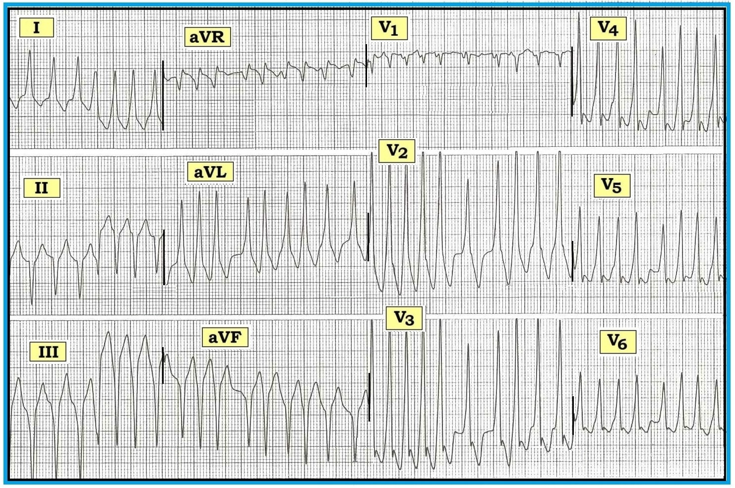 ECG Interpretation: ECG Blog #37 — AFib and Lead Reversal?