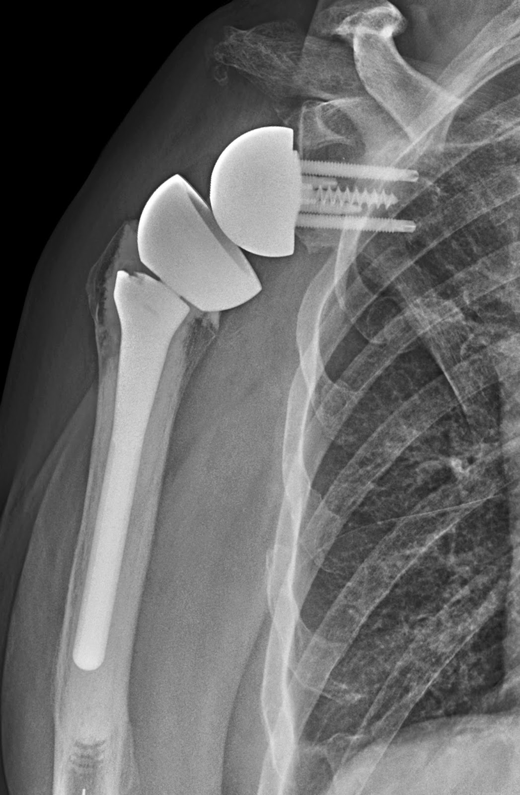 UW Shoulder and Elbow Academy: Reverse total shoulder joint replacement ...