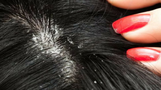 POR QUE APARECE CASPA EN EL CABELLO: QUE ES, TIPOS, CAUSAS Y REMEDIOS - ♥