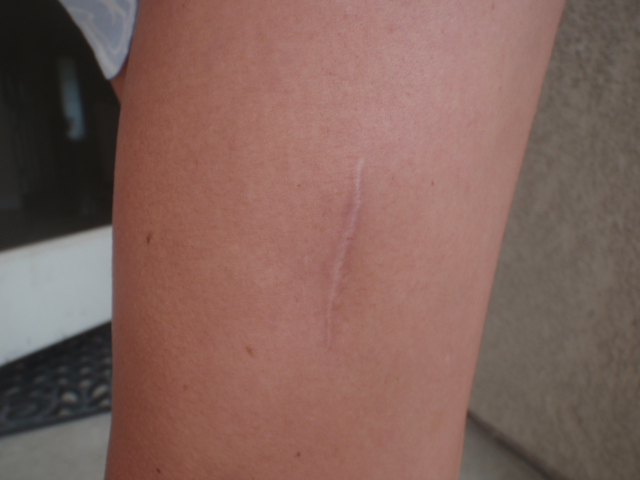 Happily Ever After: Lesson from my scar
