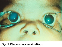 Eye 2 Eye Optometrists: Pediatric Glaucoma