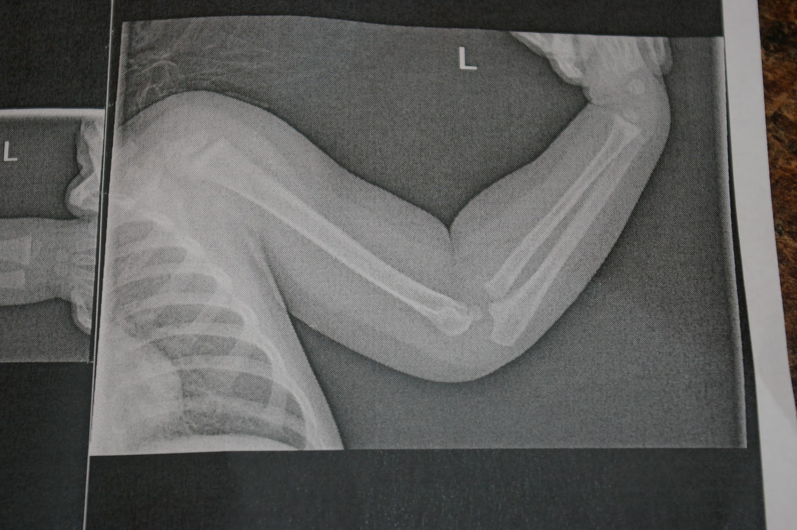 Sheldon&Miriam Reece&Reagan: Reagan's X-Rays!!