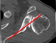 Shoulder Arthritis / Rotator Cuff Tears / Shoulder Pain : Glenoid ...