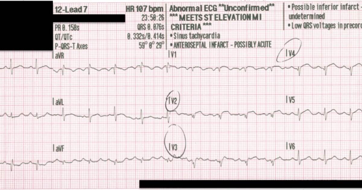 Dr. Smith's ECG Blog: Anterorlateral STEMI? Old Anterior MI? But cath ...