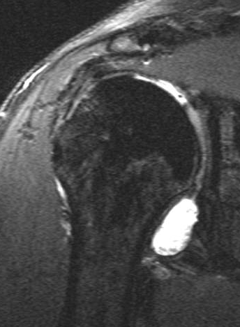 Shoulder Arthritis / Joint Replacement : Post arthroscopic focal ...