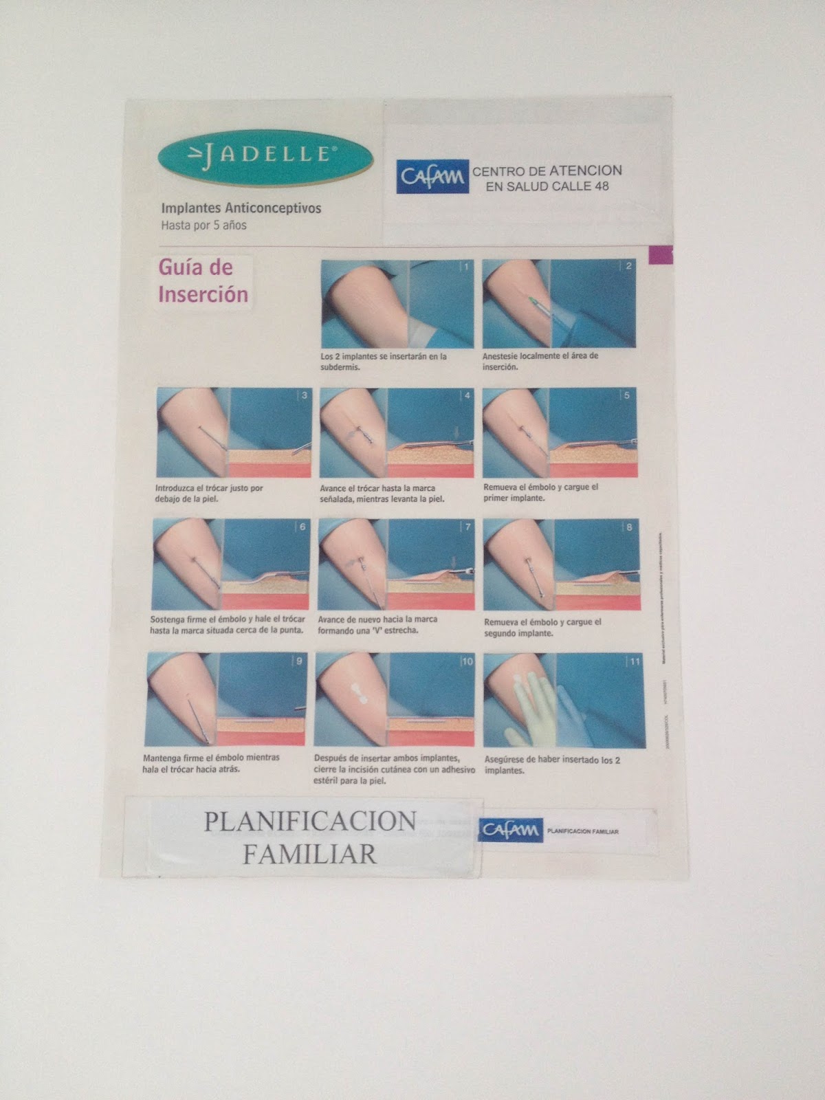 Jadelle Tu Mejor Opción: Guía inserción