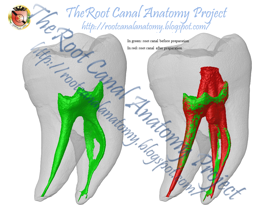 The Root Canal Anatomy Project: Conservative Endodontic Access ...