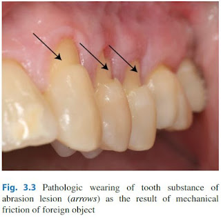 Dentosphere : World of Dentistry: Tooth Sensitivity / Dentin ...