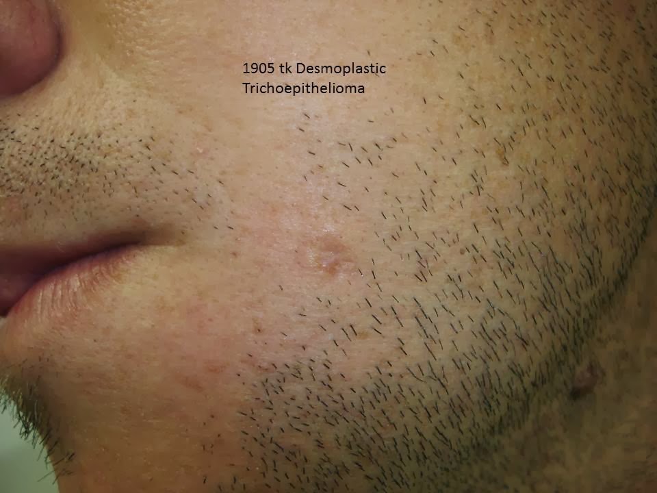 Differential Diagnosis in Dermatopathology: Desmoplasia